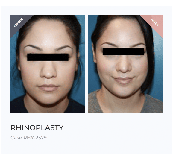 The Guide to Bulbous Nose Rhinoplasty | Wide Nasal Tip Surgery